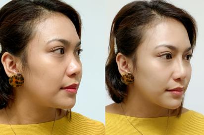 Get A Higher Nose Bridge and Sharper Nose Tip Instantly with PDO Nose ...