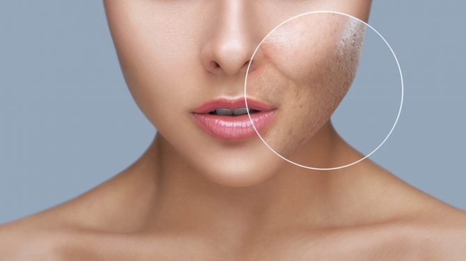 Best Acne Scar Removal Treatments In Singapore Weekender Com Sg
